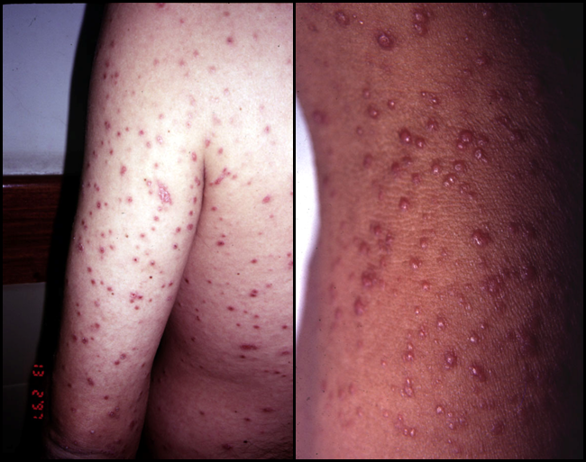 Histoplasmosis Diseminada Y Progresiva Pdh Life Worldwide Es
