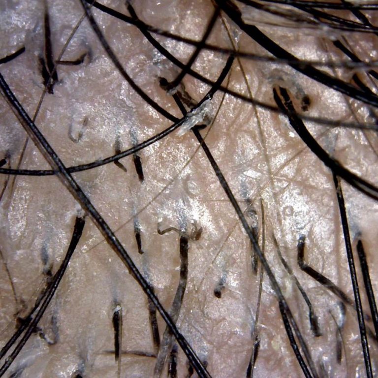 Dermatoscopía - Life Worldwide ES