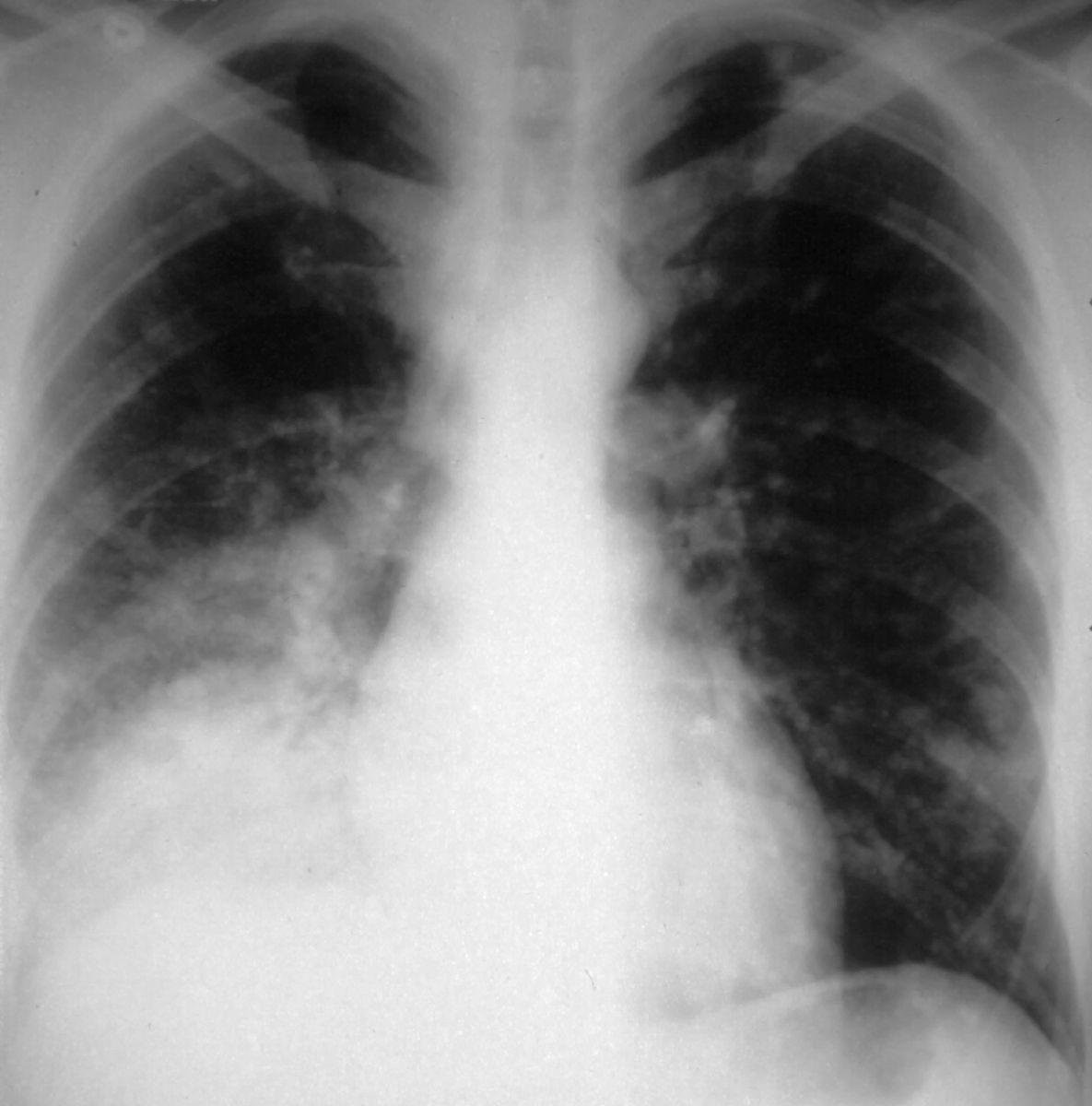 Micosis endémicas - Life Worldwide ES