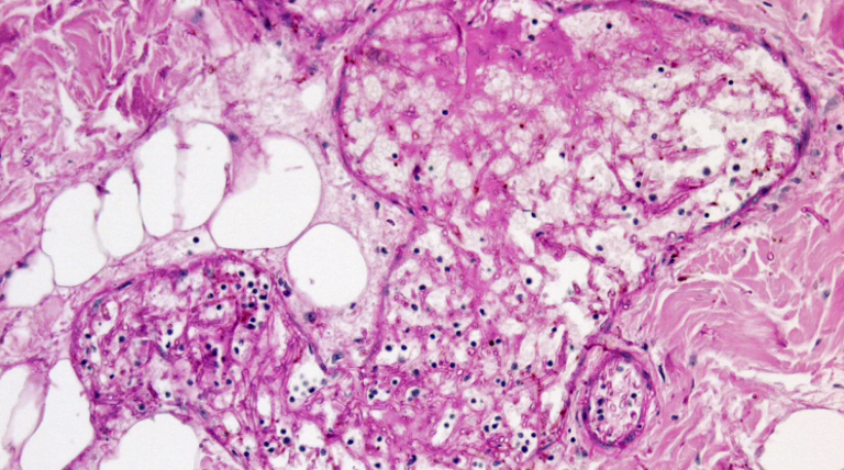 Turkish review of mucormycosis in children shows high mortality rate ...